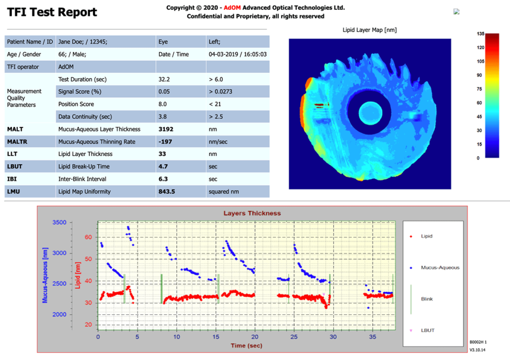 TFI Technology – Tear Film Imager